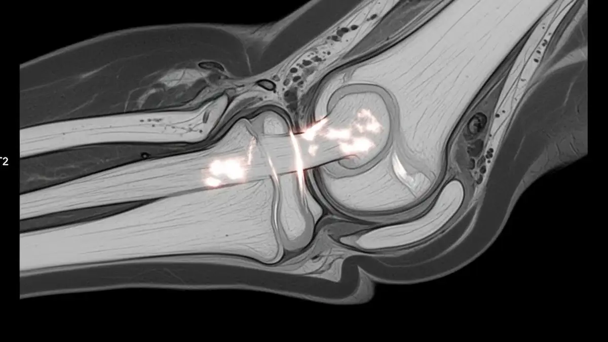 Lesão do ligamento colateral medial: sintomas e tratamento